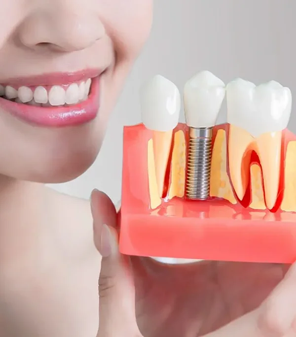 Straumann Implants in Delhi, India | Certified Provider & Cost