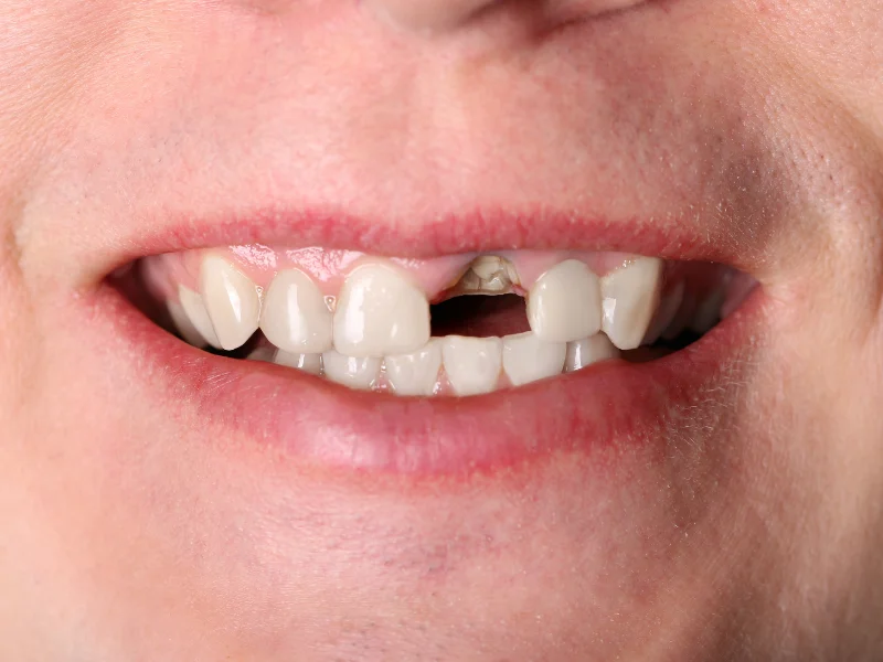 My Front Tooth Is Loose: What Can I Do? - Tips and Guidance