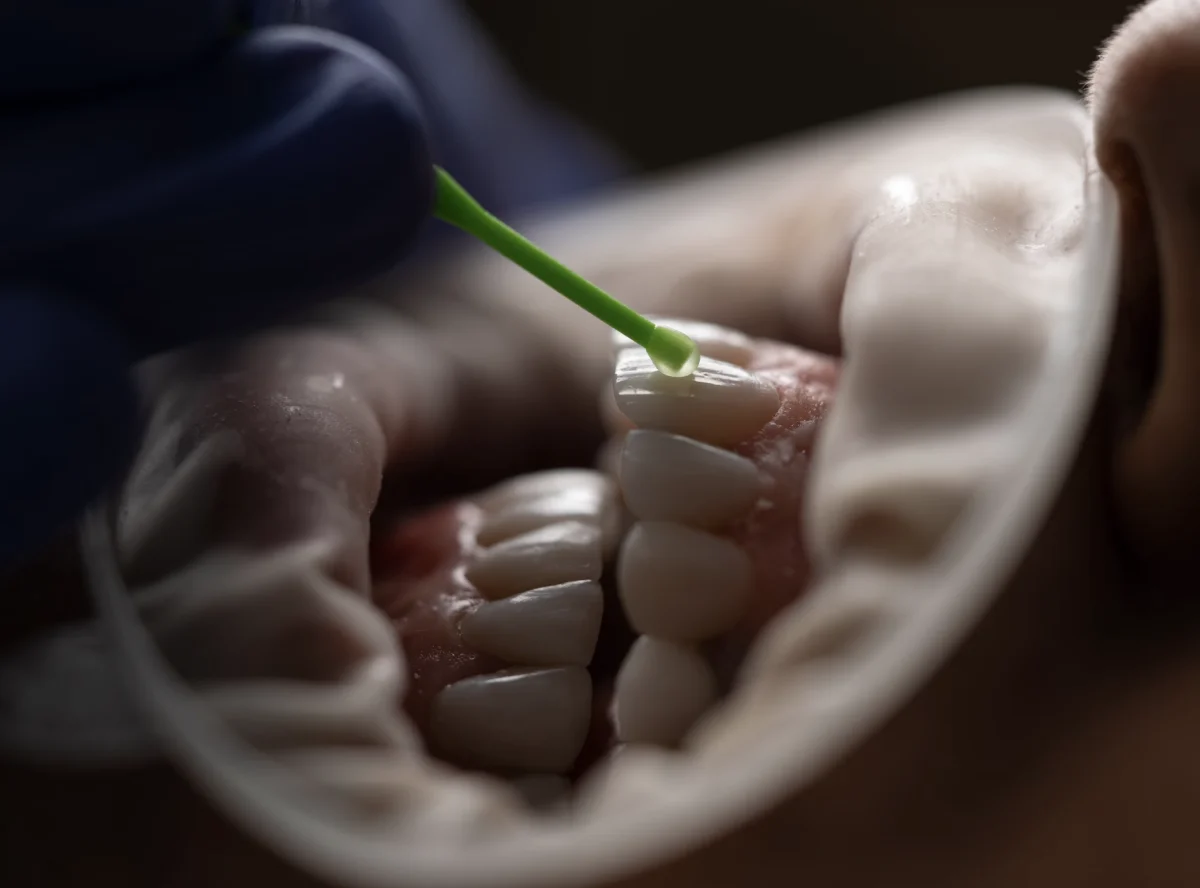 Understanding Different Types of Tooth Stains and Effective Removal Methods