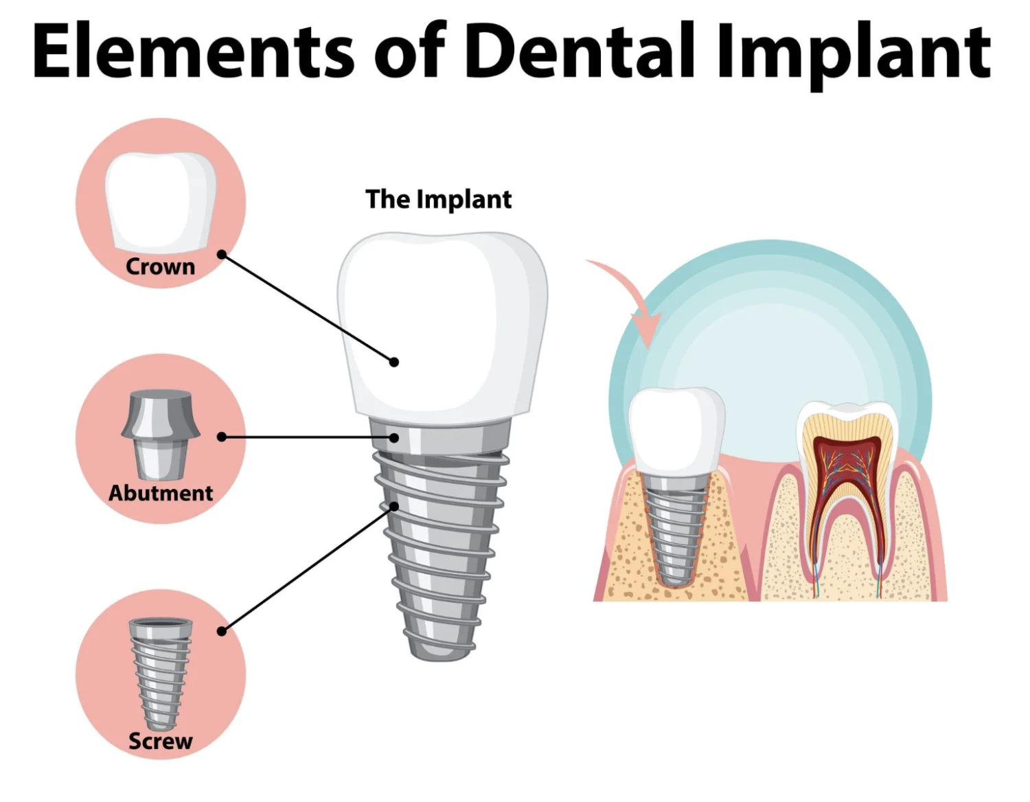 Titanium Implant Side Effects and How to Minimize Your Risk