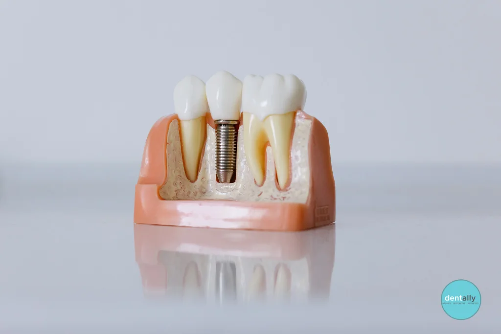 Best Countries for Dental Implants in 2026: A Comprehensive Guide