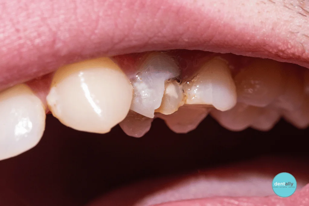 How to Restore Tooth Enamel: A Complete Guide to Protecting Your Smile 醴