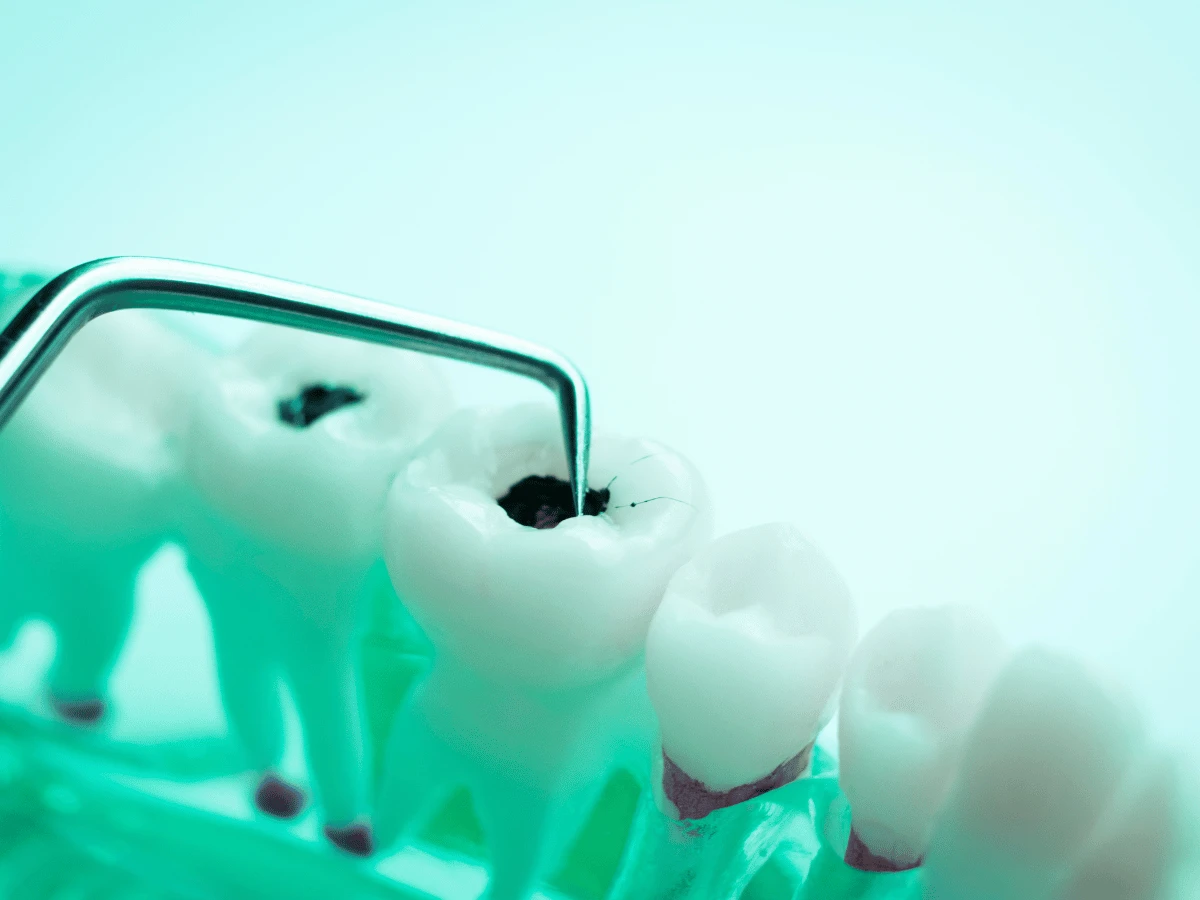 Seeing Black Lines on Your Teeth? It Might Not Be a Cavity. A Dentist ...